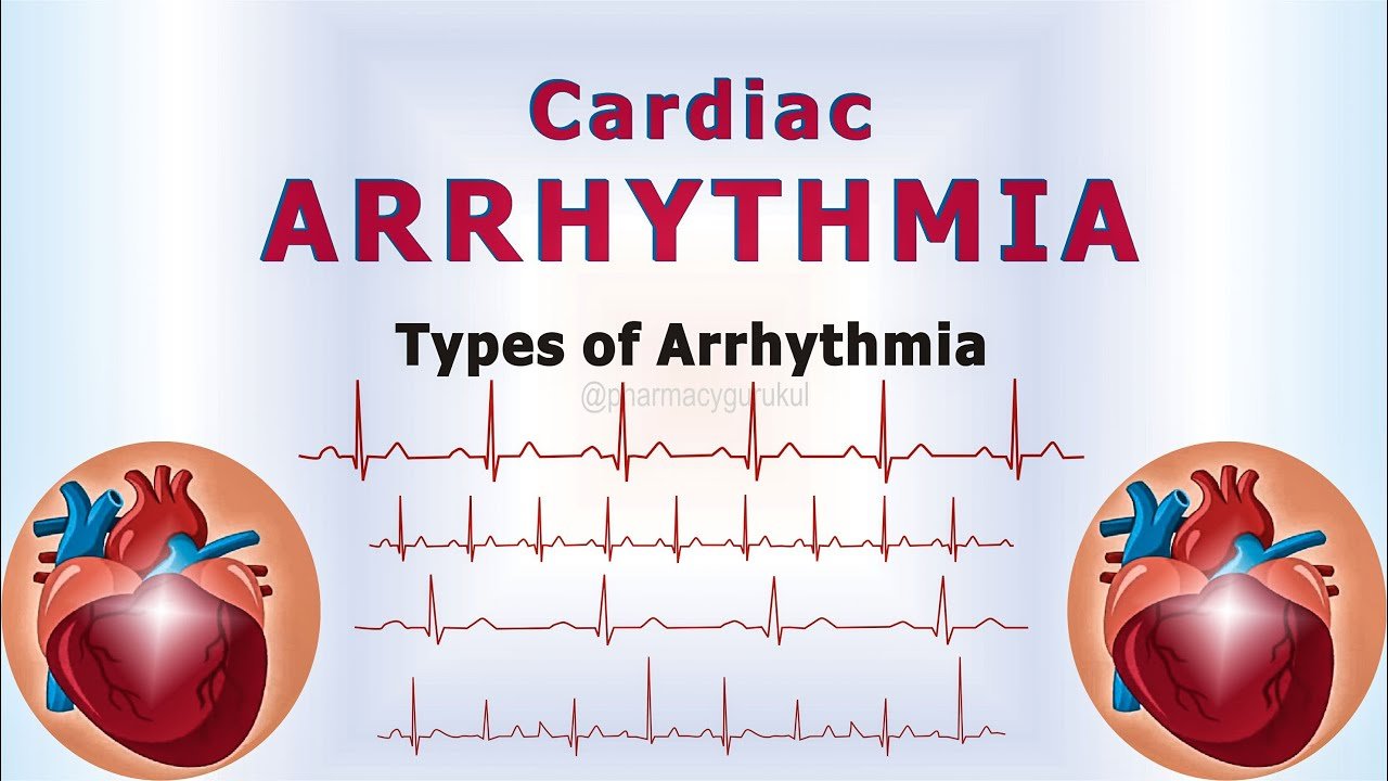 Orthodromic Atrioventricular Reciprocating Tachycardia (AVRT)